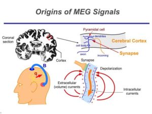 What is Magnetoencephalography (MEG)? | I-LABS